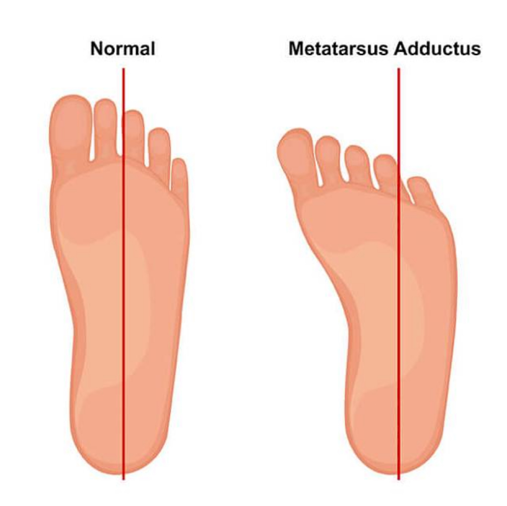 In-toeing - Upside Kids Physio
